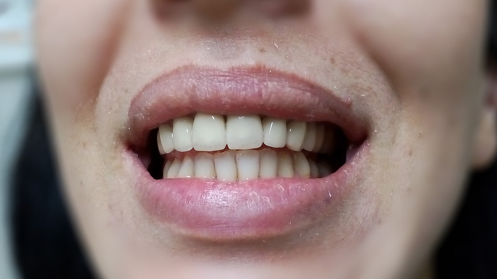 Gubitak bočnih zuba u gornjoj vilici, narušena estetika - Green Dental Niš